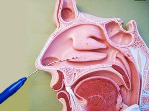 Turbinate Reduction Through Radiofrequency (Inferior concha RF ...